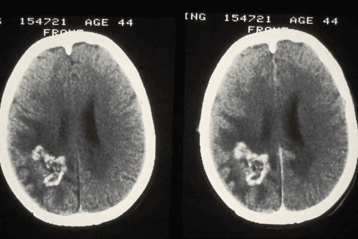 Malignant Brain Tumor MRI: 7 Key Signs - Liv Hospital